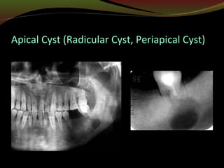 4. cyst & cystlike lesion of the jaw (2) (1) | PPT