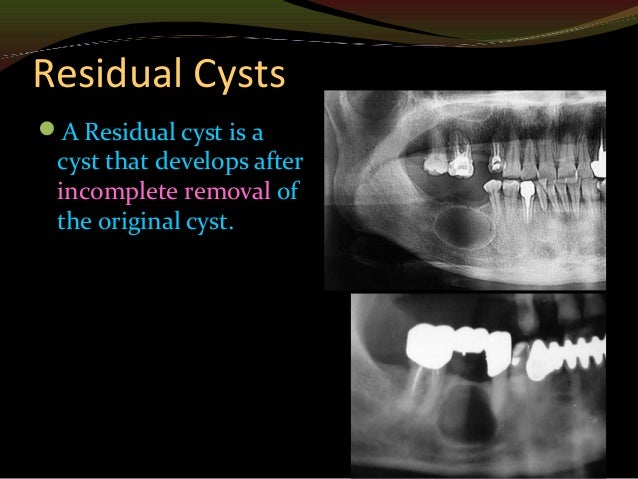 4. cyst & cystlike lesion of the jaw (2) (1)