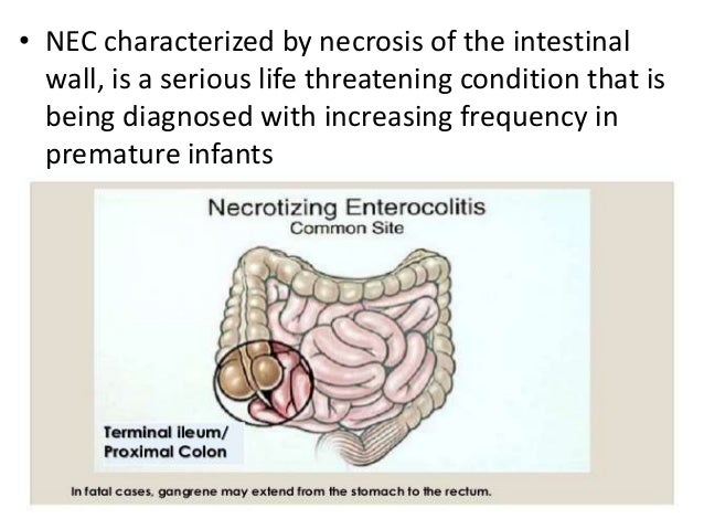 NECROTIZING ENTEROCOLITIS