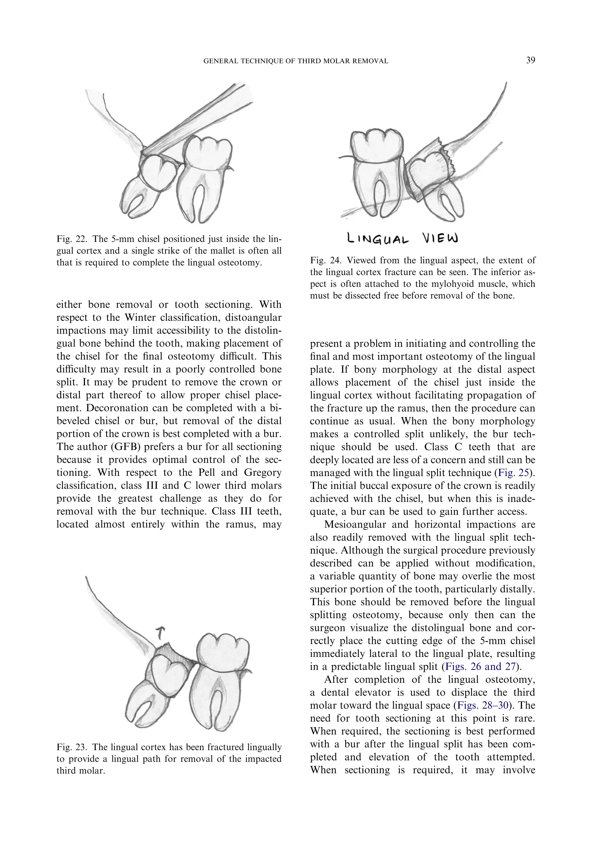 General Technique of Third Molar Removal | PDF