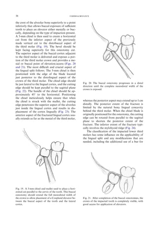 General Technique of Third Molar Removal | PDF