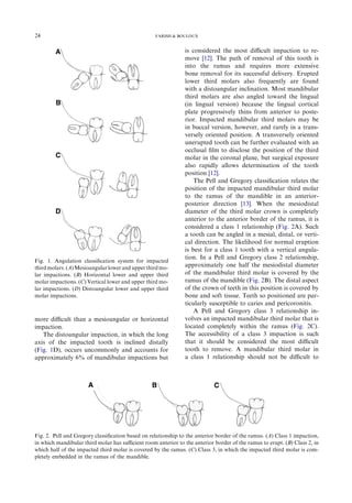 General Technique of Third Molar Removal | PDF