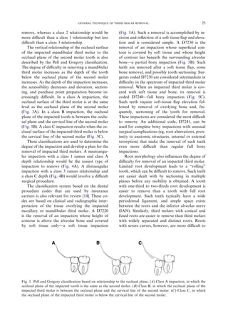 General Technique of Third Molar Removal | PDF