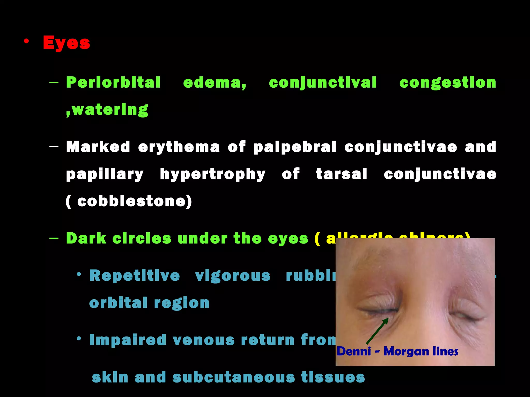 Allergic rhinitis | PPT