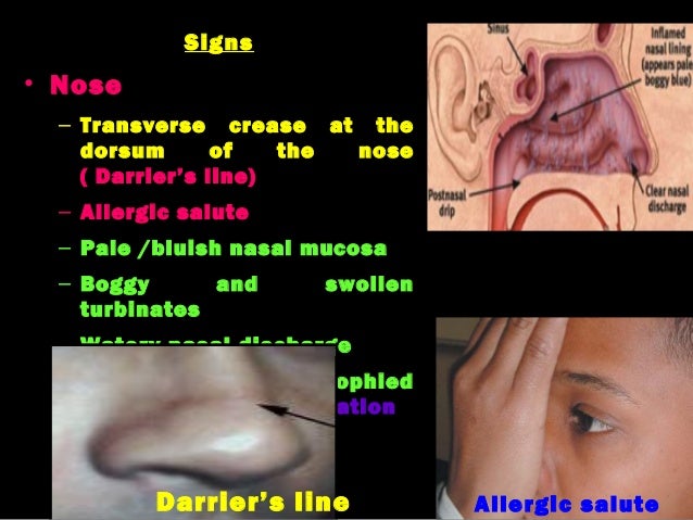 Erythematous Turbinates
