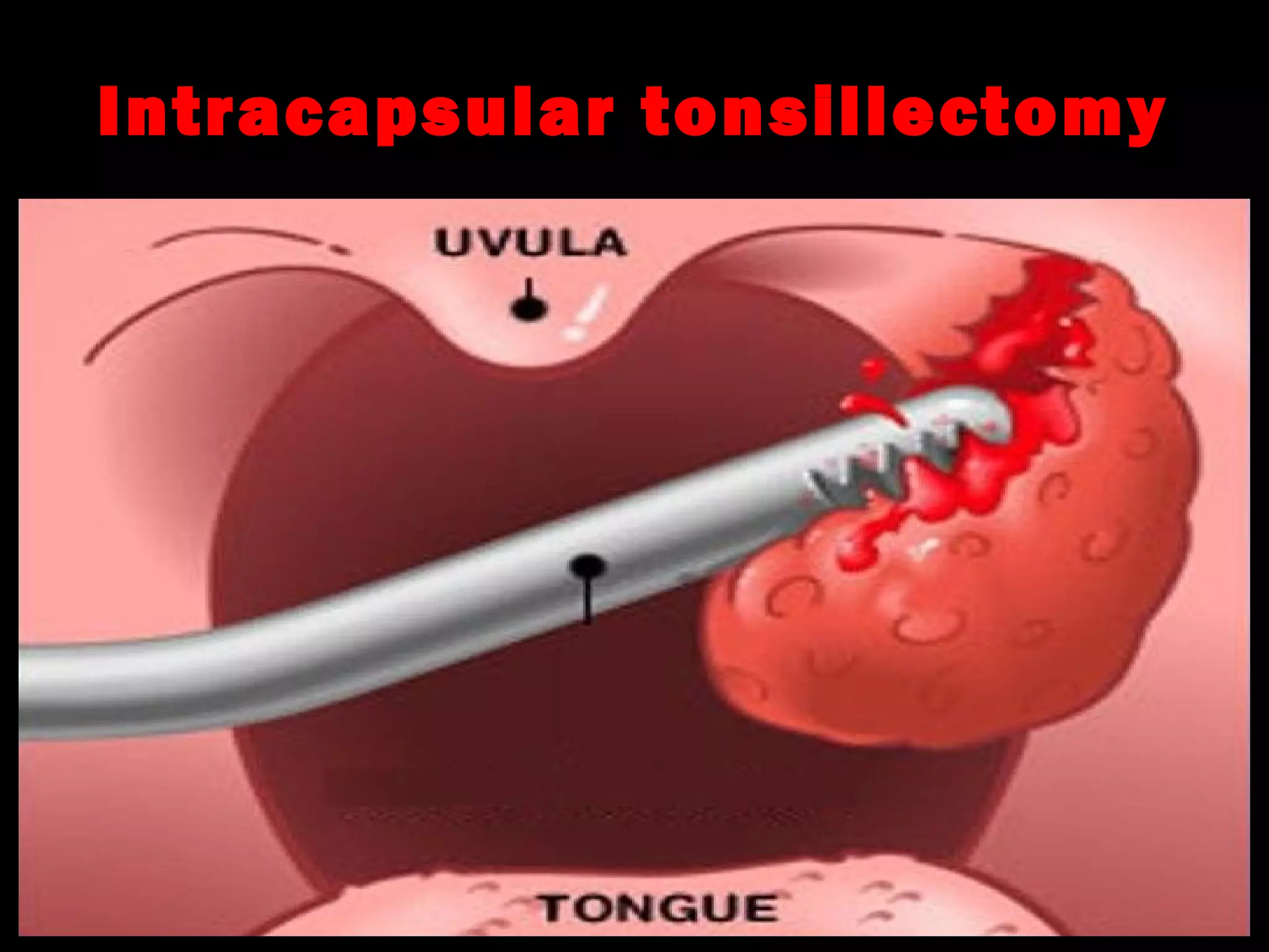Tonsillectomy, adenoidectomy and quinsy | PPT