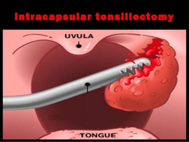 4.tonsillectomy, adenoidectomy and quinsy