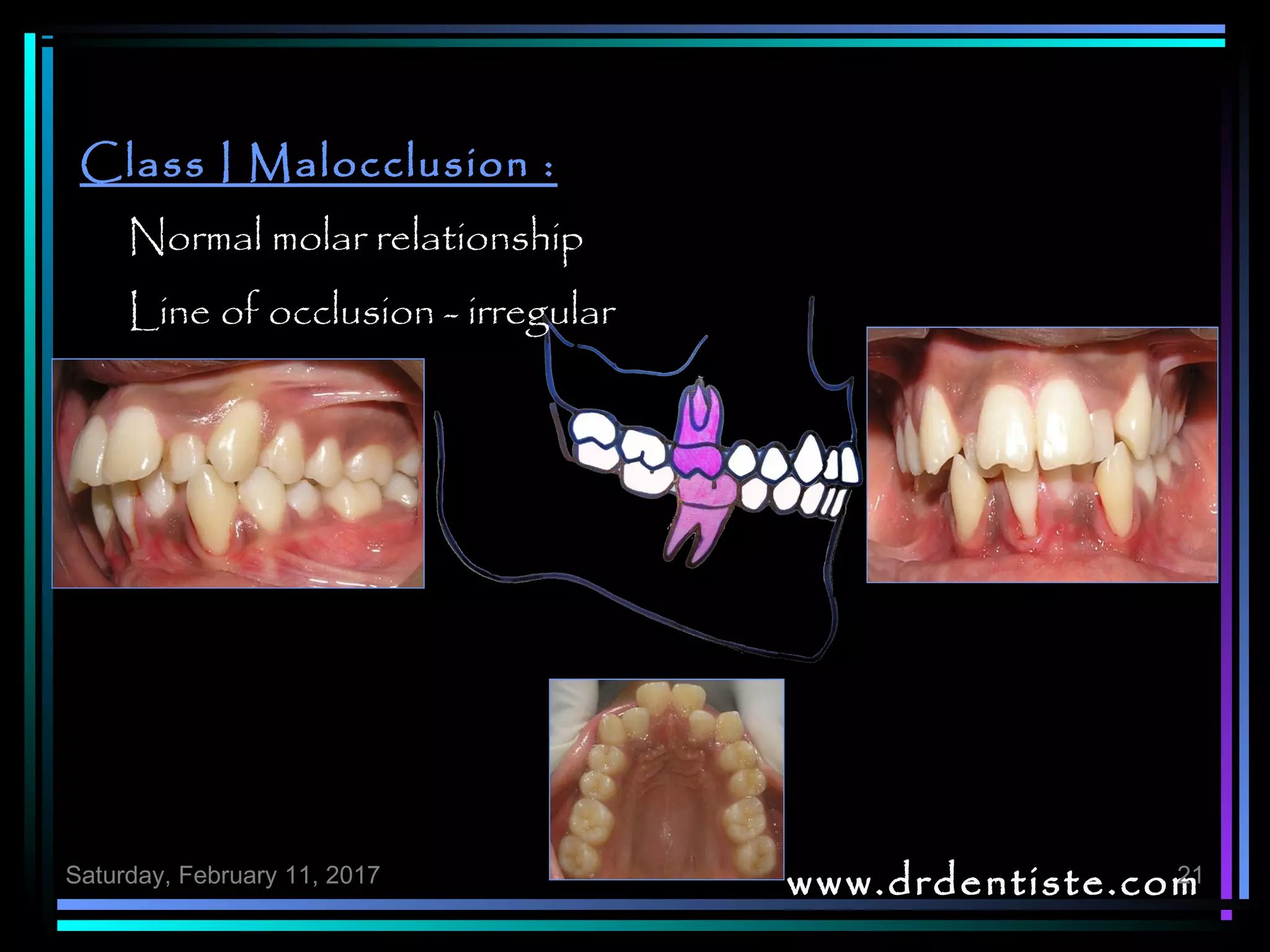 classification of malocclusion | PPT