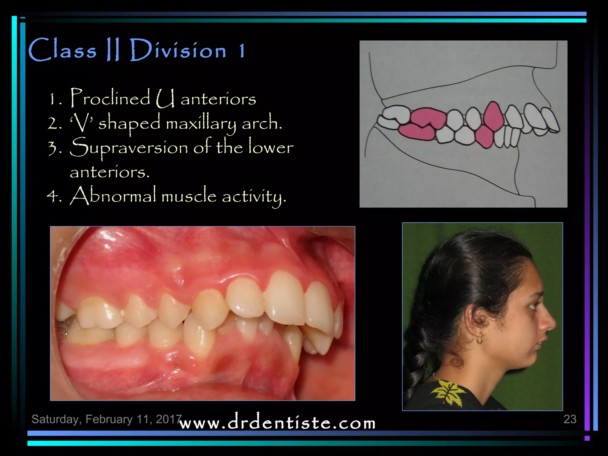 classification of malocclusion | PPT