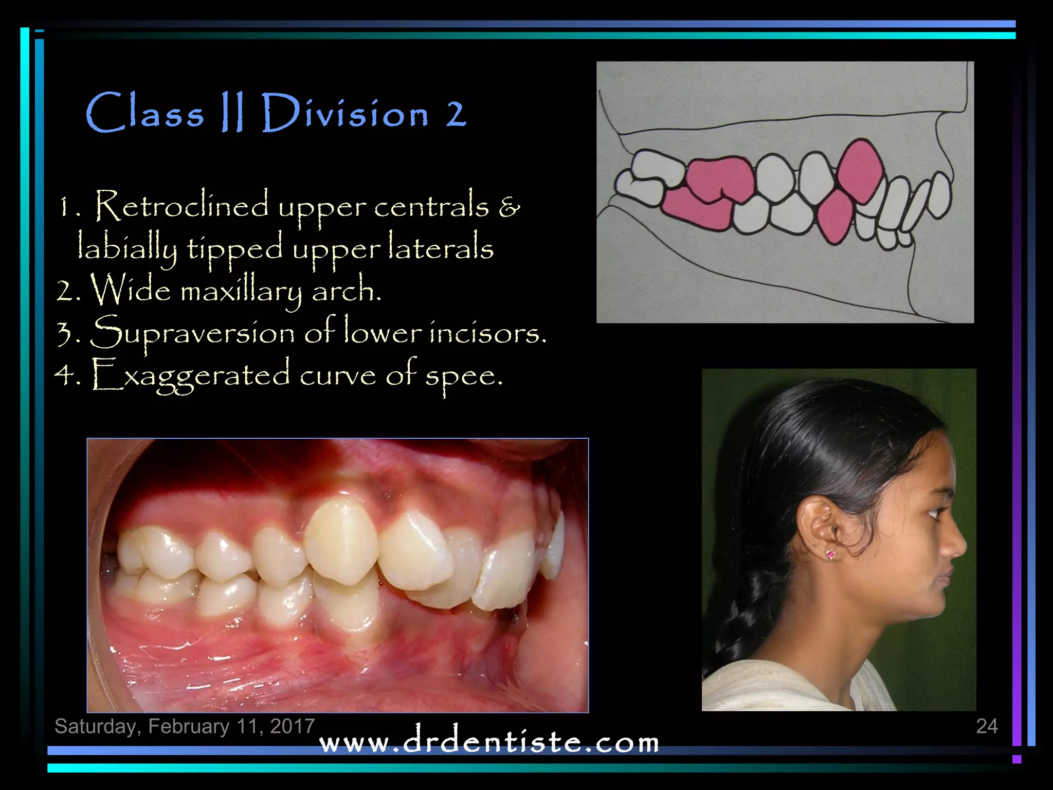 classification of malocclusion | PPT