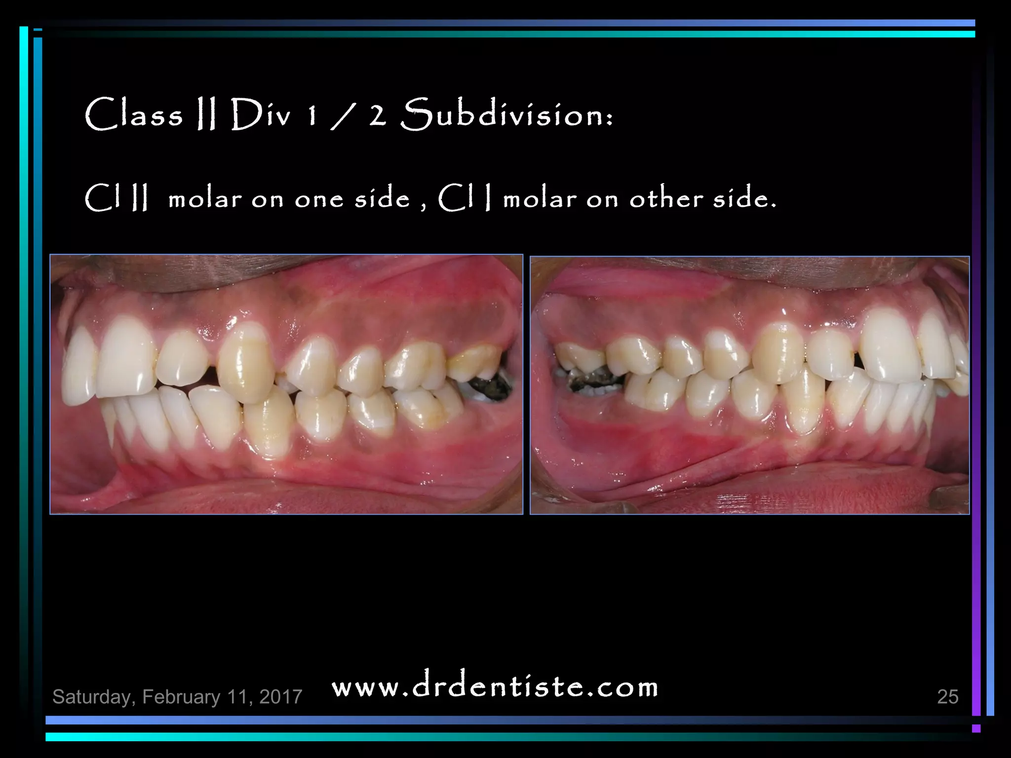 classification of malocclusion | PPT