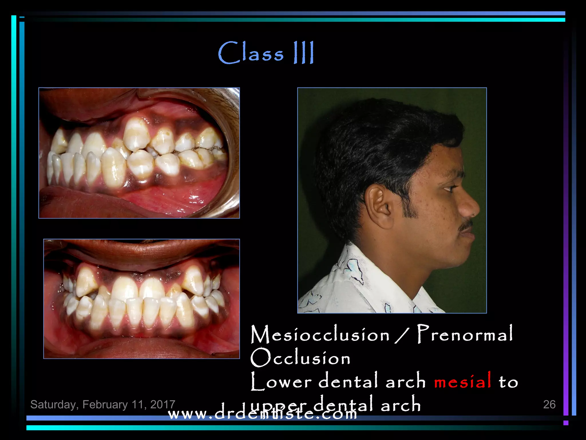 classification of malocclusion | PPT