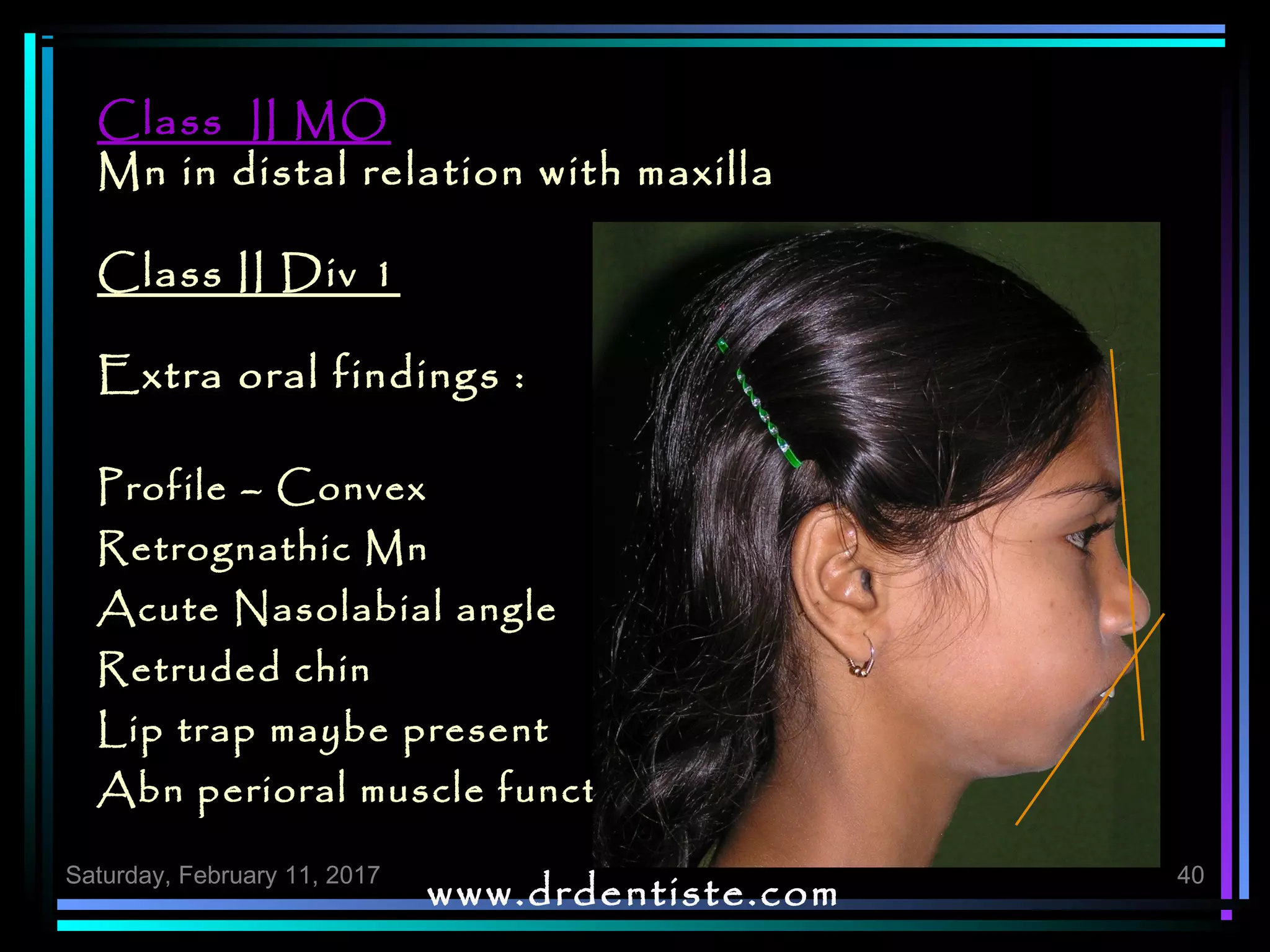 classification of malocclusion | PPT