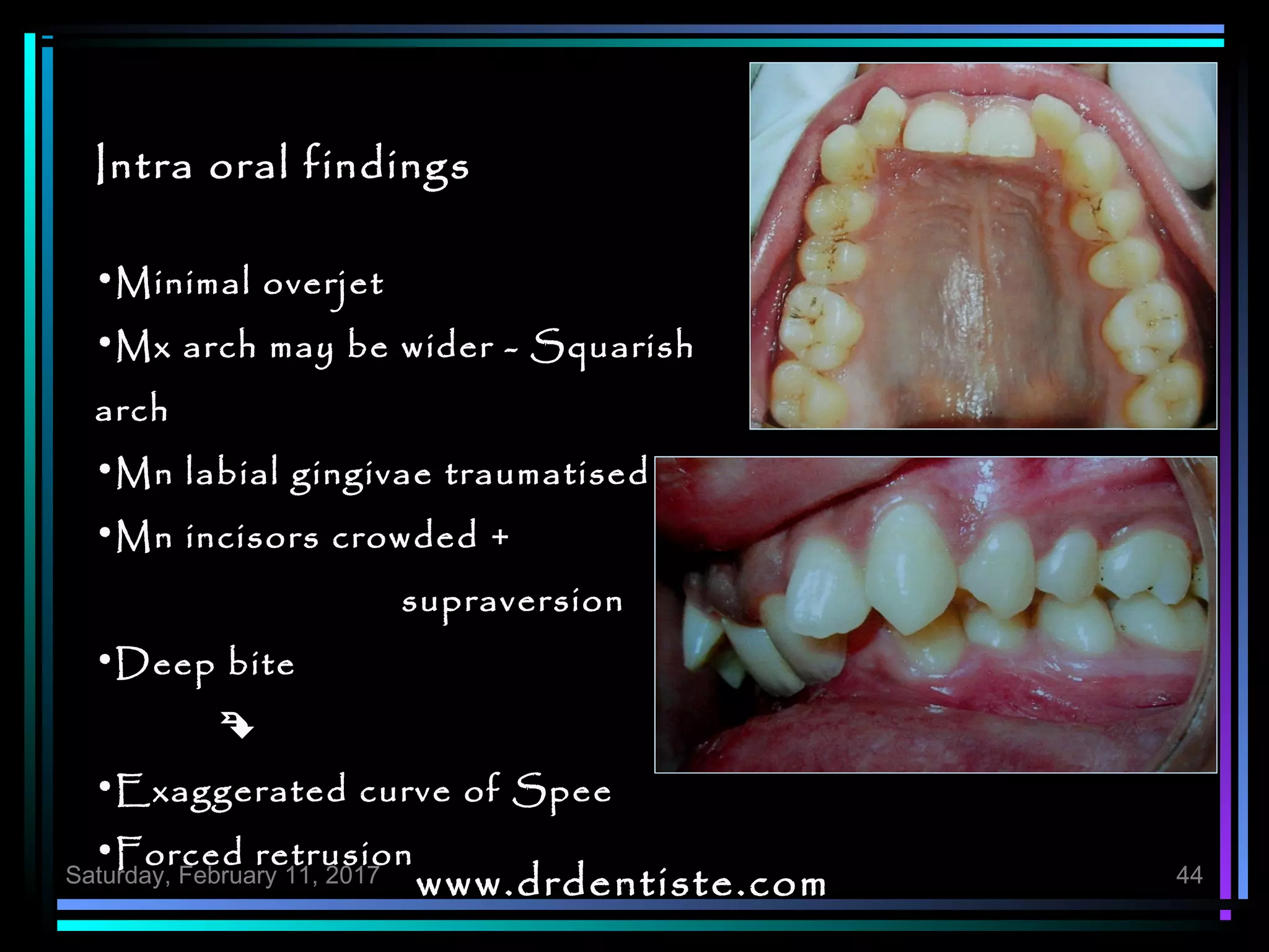 classification of malocclusion | PPT