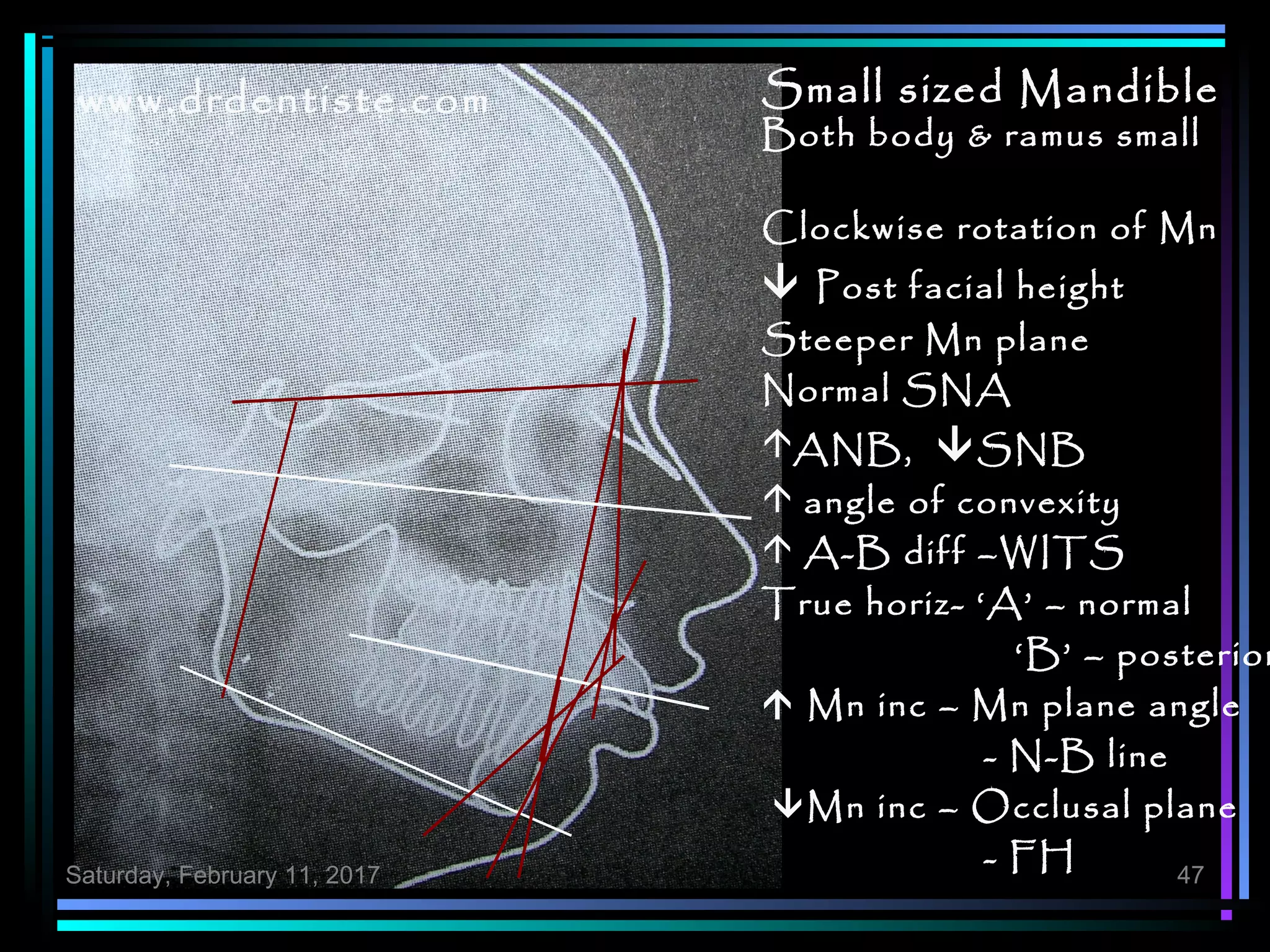 classification of malocclusion | PPT
