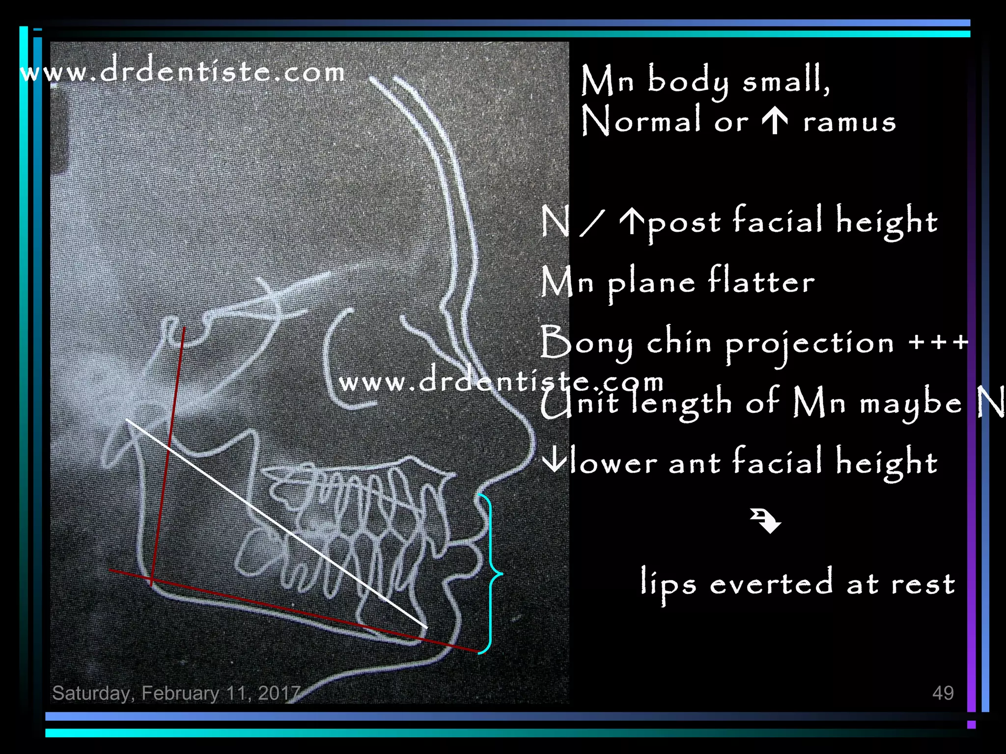 classification of malocclusion | PPT