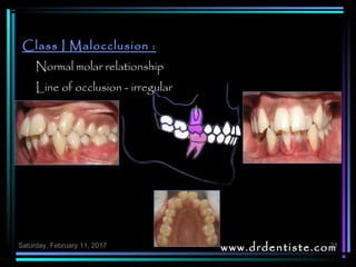 classification of malocclusion | PPT
