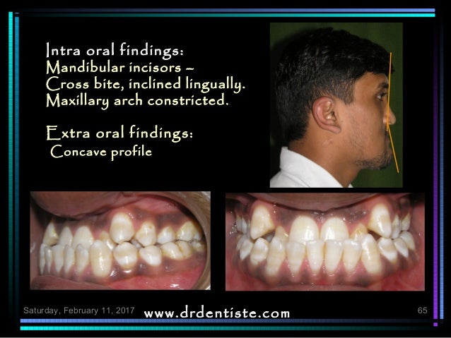 classification of malocclusion