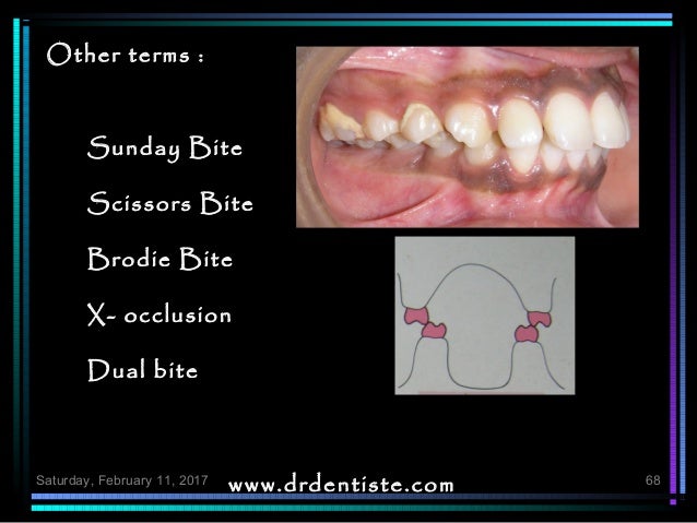 classification of malocclusion