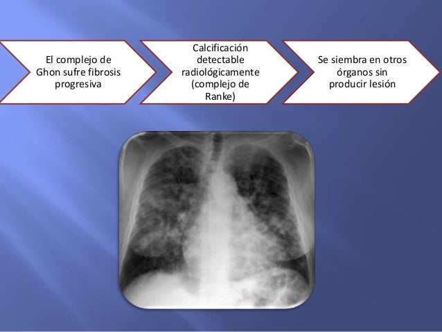 Tuberculosis