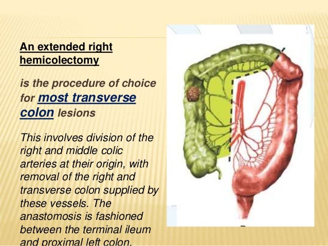 TREATMENT OF RIGHT COLONIC CANCER