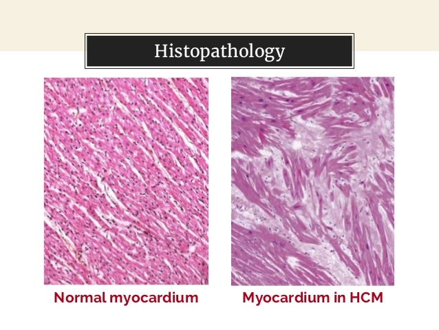 Cardiology 4.6. Hypertrophic Cardiomyopathy HCM - Dr. Farjad Ikram