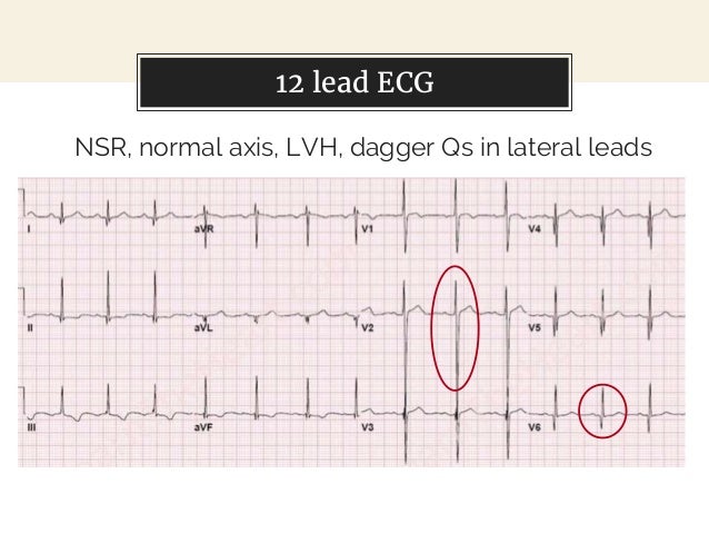 Cardiology 4.6. Hypertrophic Cardiomyopathy HCM - Dr. Farjad Ikram