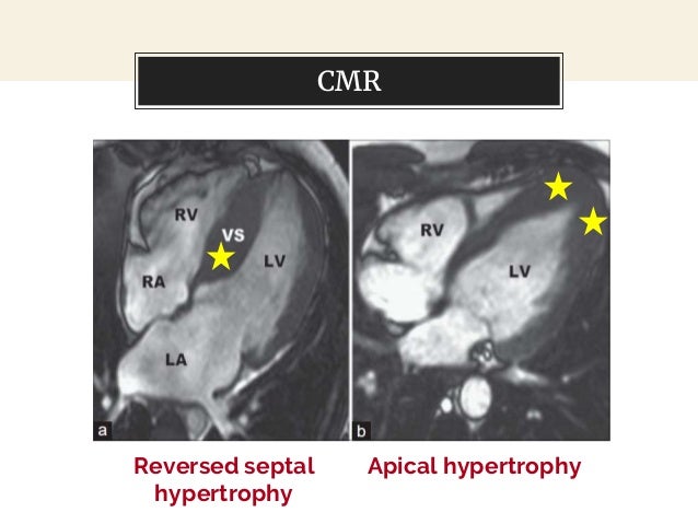 Cardiology 4.6. Hypertrophic Cardiomyopathy HCM - Dr. Farjad Ikram