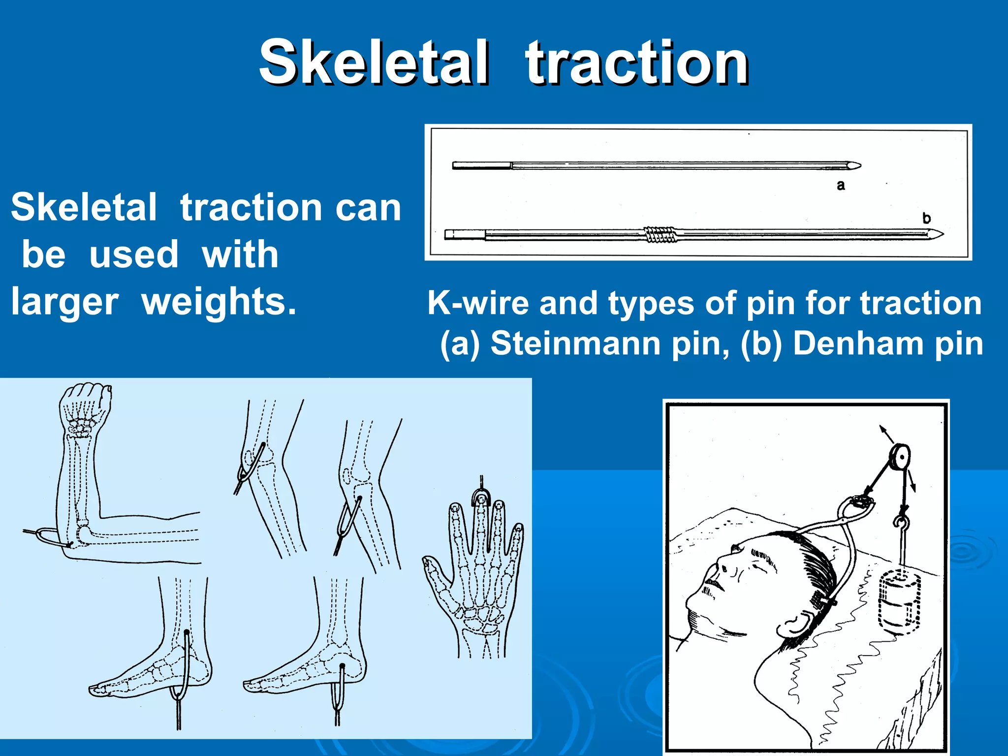 Management of Fractures | PPT