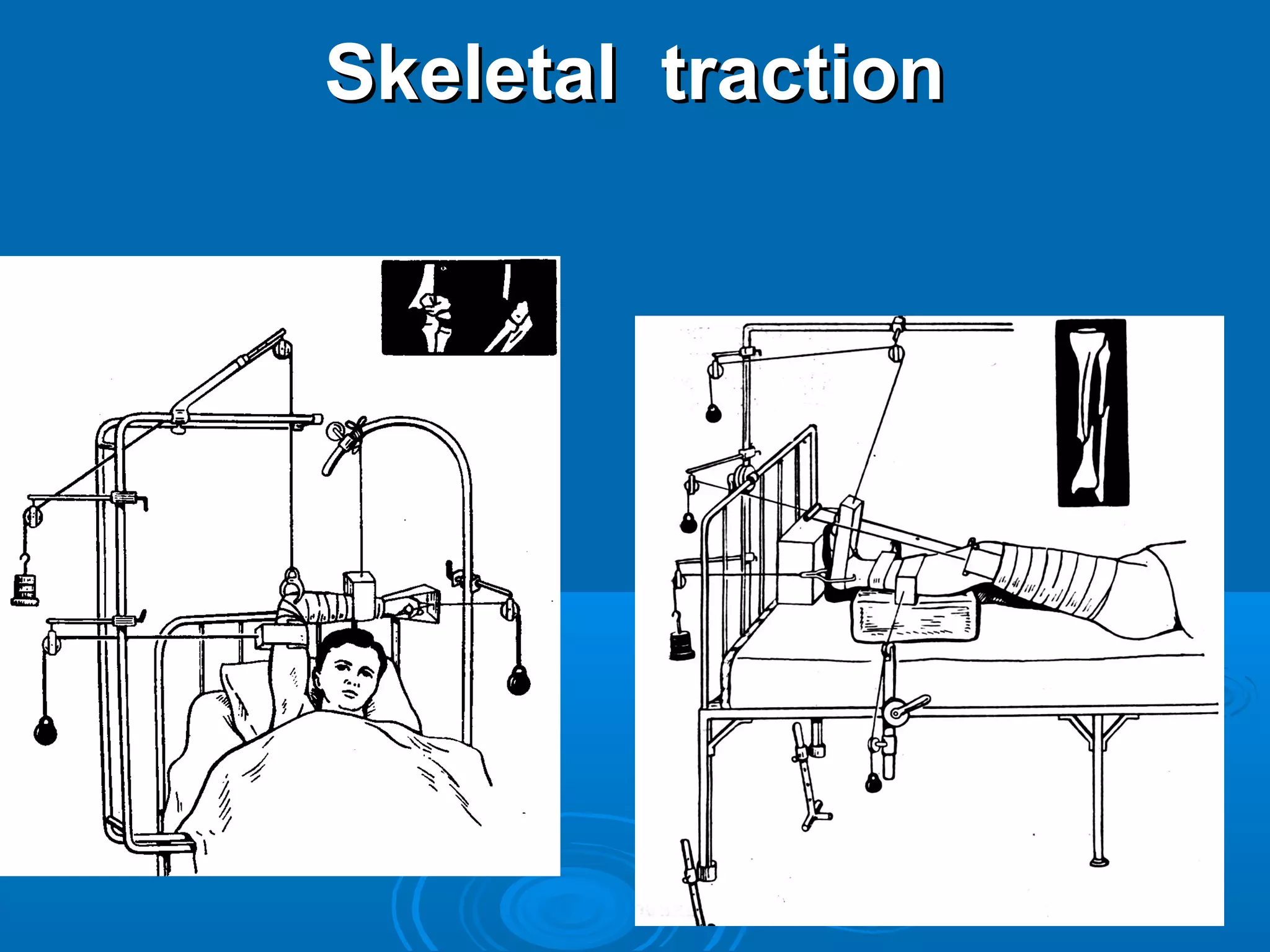 Management of Fractures | PPT