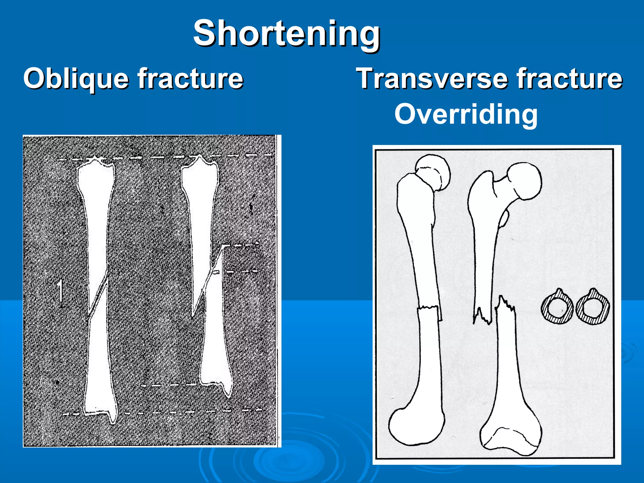 Management of Fractures | PPT