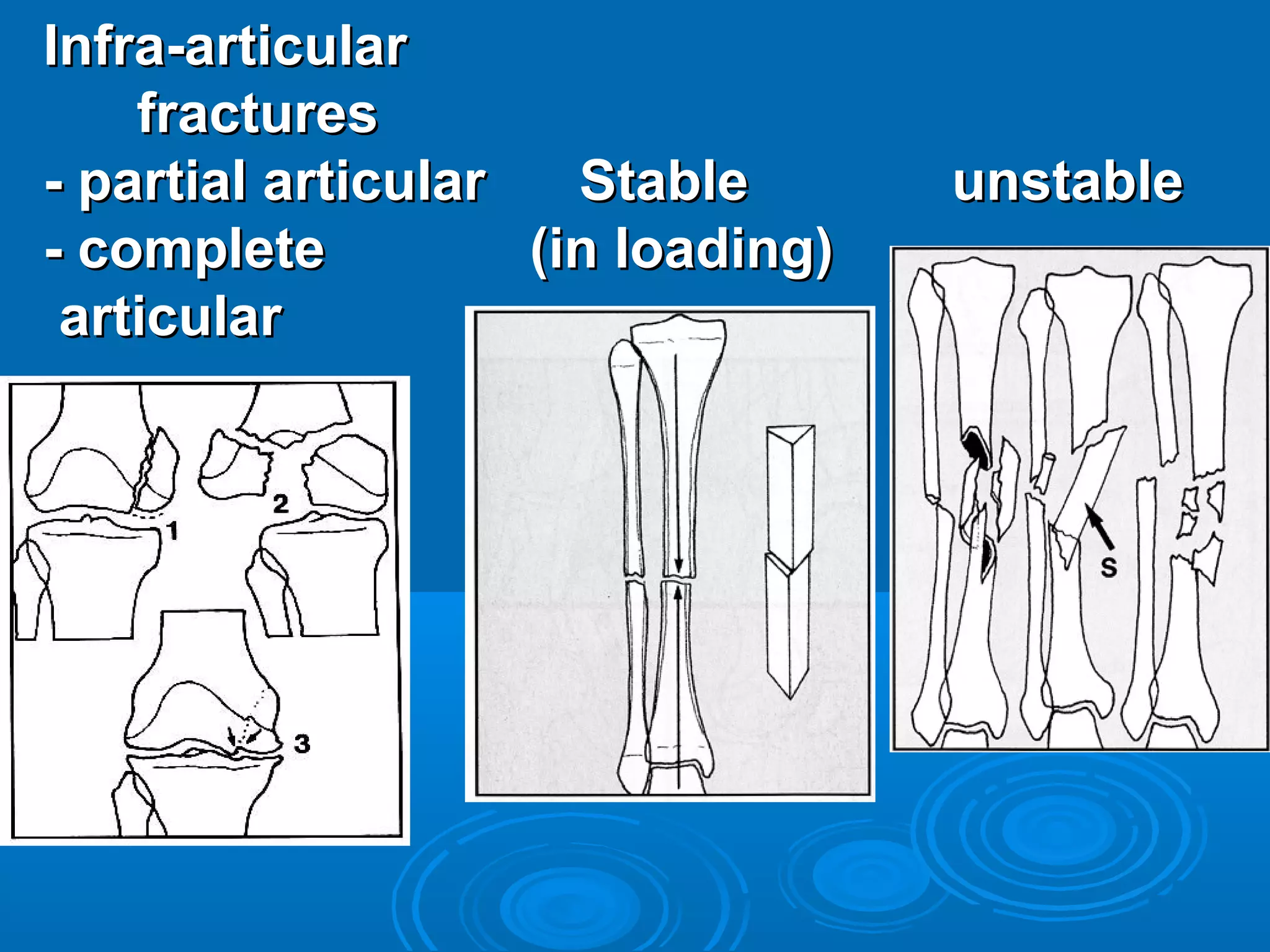Management of Fractures | PPT