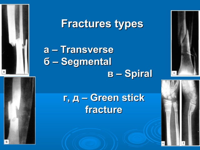 Management of Fractures | PPT