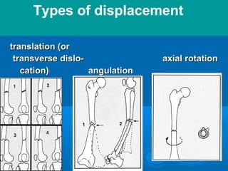 Management of Fractures | PPT