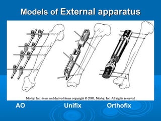 Management of Fractures | PPT