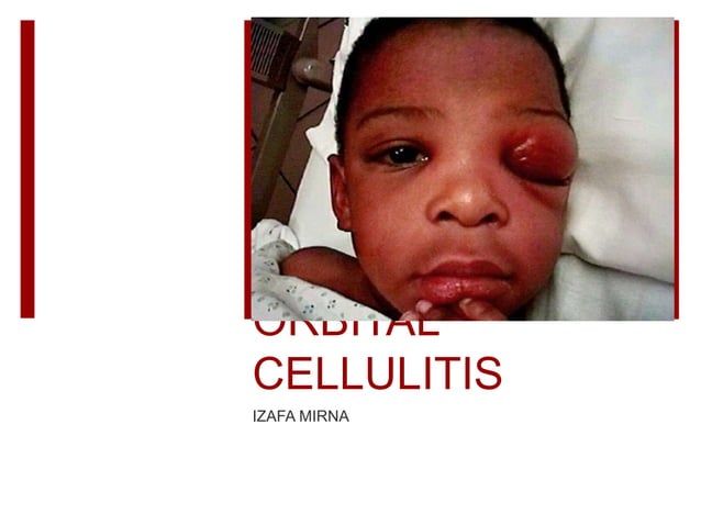 orbital cellulitis | PPTX