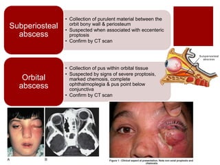 orbital cellulitis | PPTX