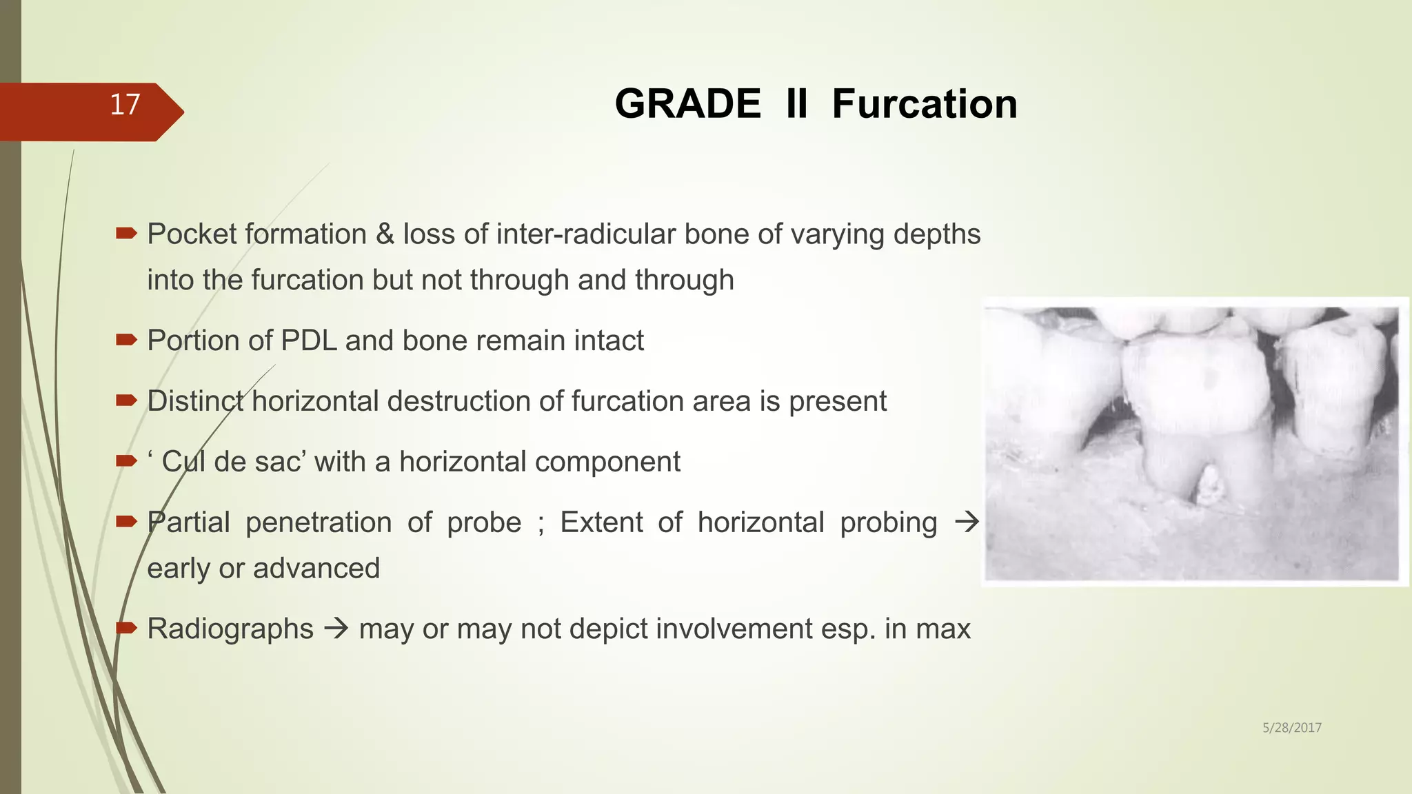 4.furcation involvement and its treatment | PPTX