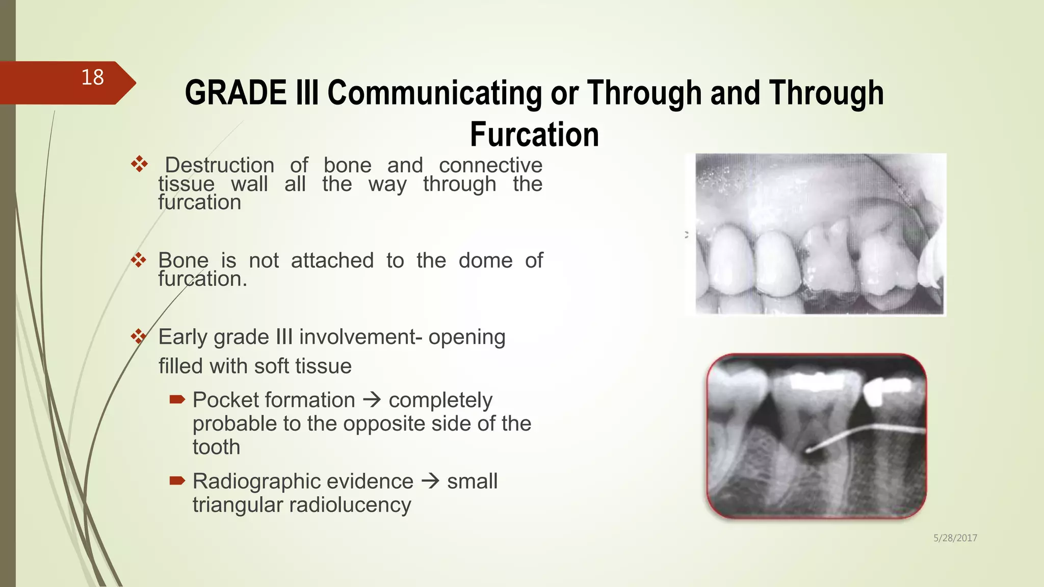 4.furcation involvement and its treatment | PPTX