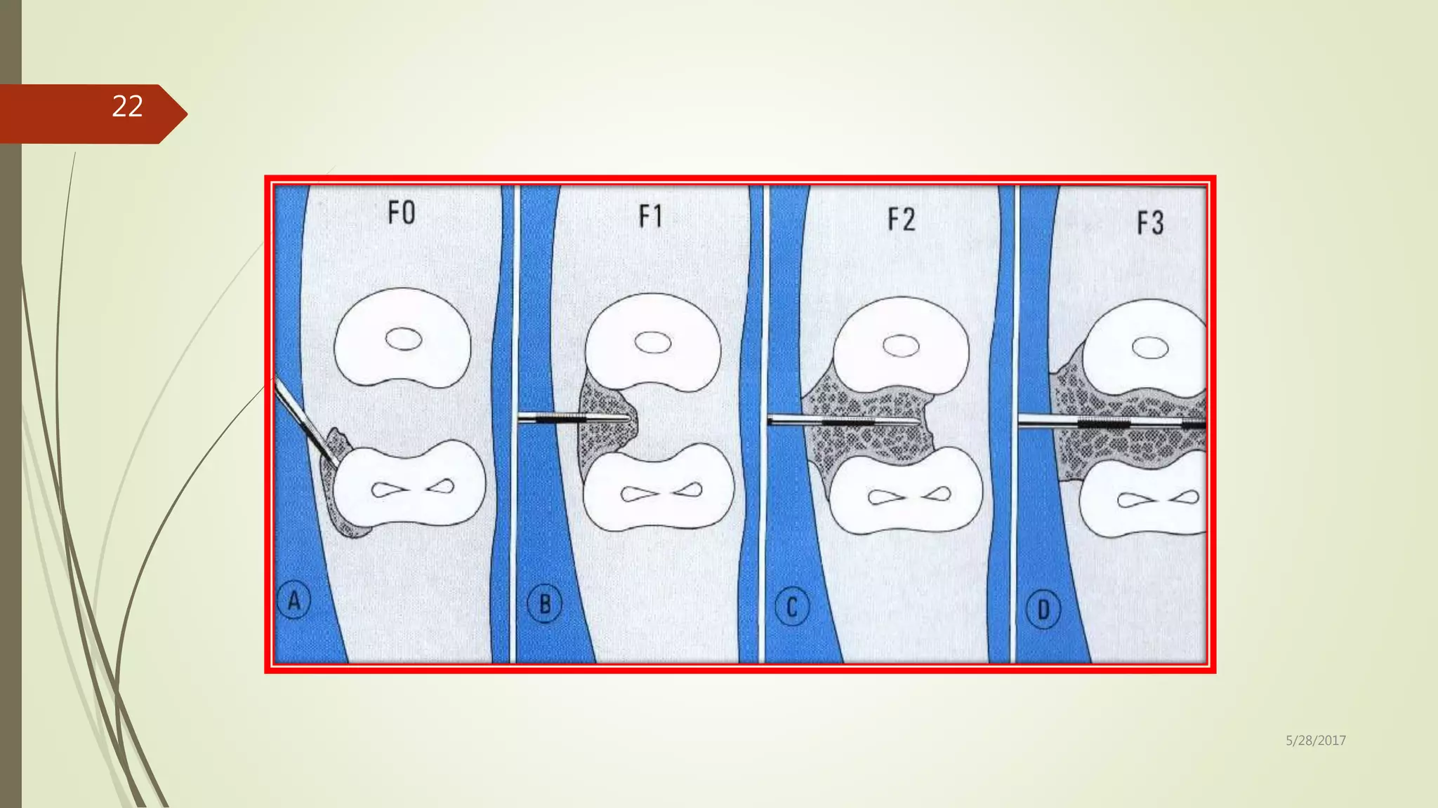 4.furcation involvement and its treatment | PPTX