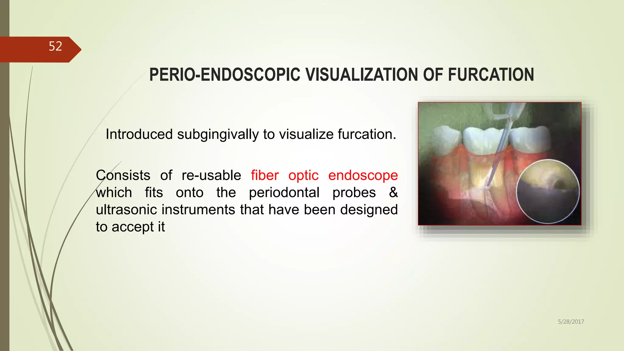 4.furcation involvement and its treatment | PPTX
