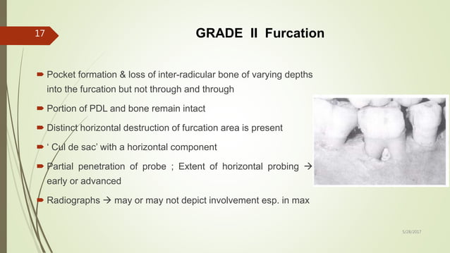 4.furcation involvement and its treatment | PPTX | Dental Health ...