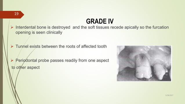 4.furcation involvement and its treatment | PPTX | Dental Health ...