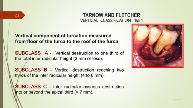 4.furcation involvement and its treatment | PPTX | Dental Health ...