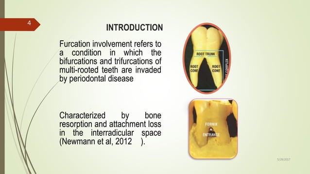 4.furcation involvement and its treatment | PPTX | Dental Health ...