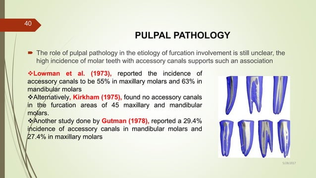 4.furcation involvement and its treatment | PPTX | Dental Health ...