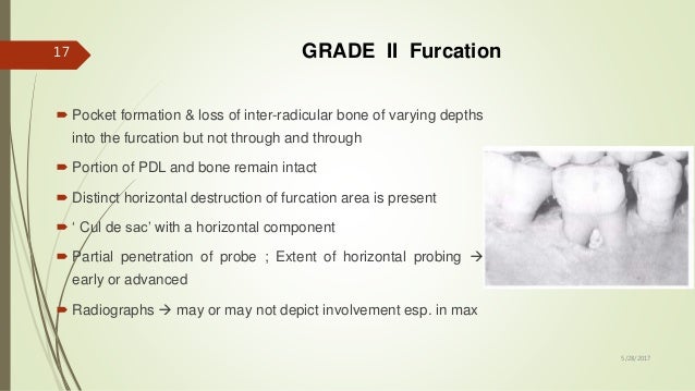 4.furcation involvement and its treatment