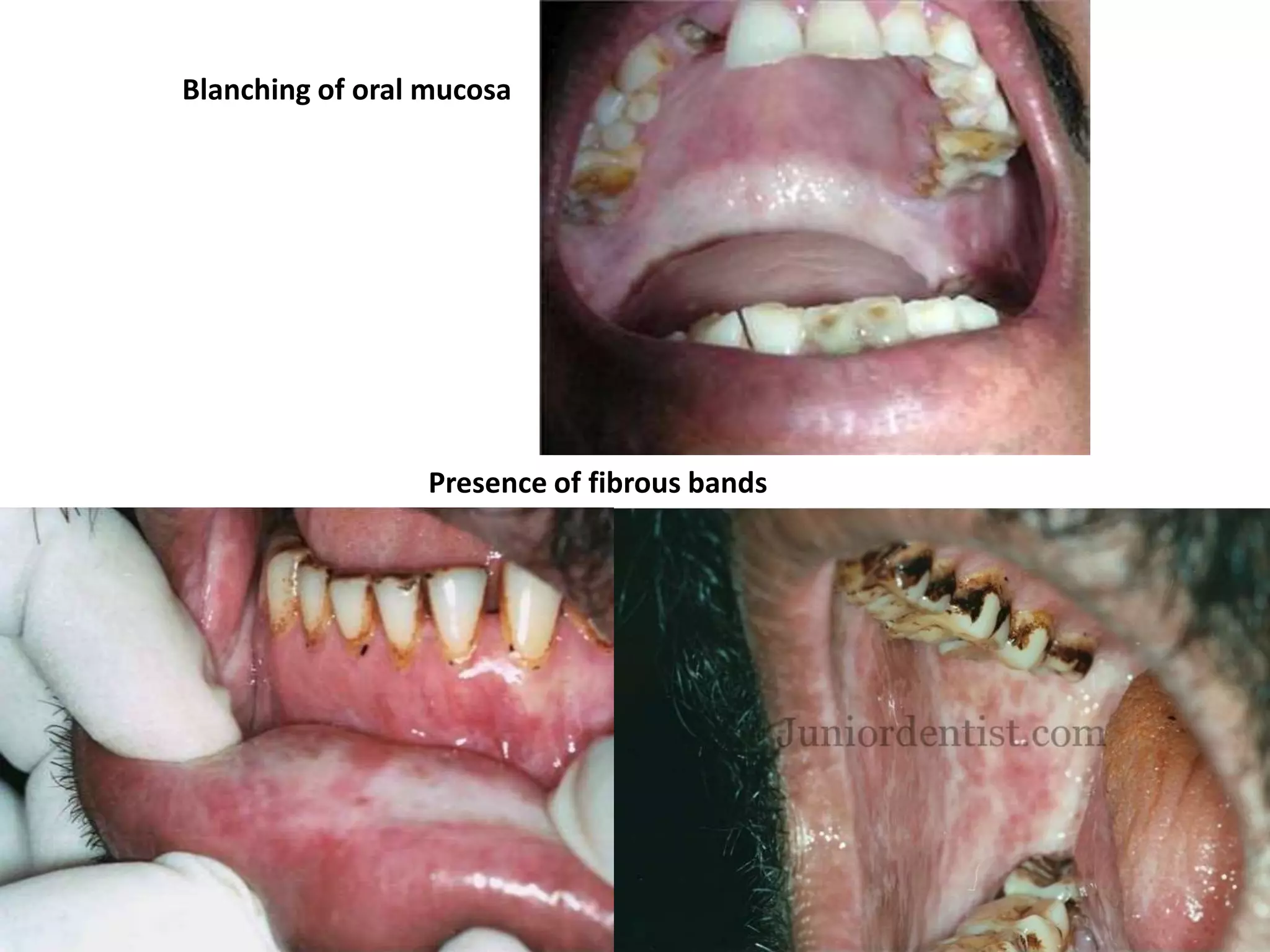 Oral Submucous Fibrosis and its Management. | PPTX