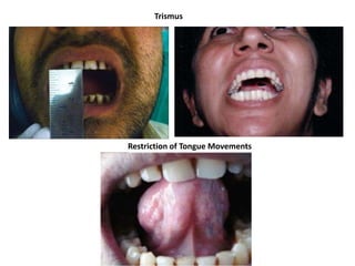 Oral Submucous Fibrosis and its Management. | PPTX