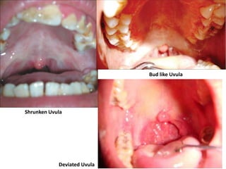 Oral Submucous Fibrosis and its Management. | PPTX